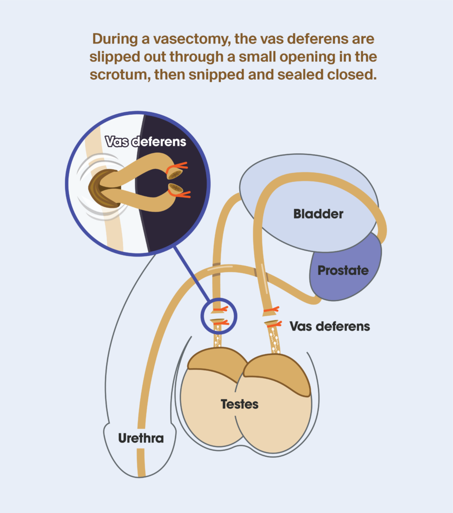 Vasectomy | Bay Area Vasectomy | Silicon Valley Urologist – Dr ... Vasectomy | Bay Area Vasectomy | Silicon Valley Urologist – Dr ...